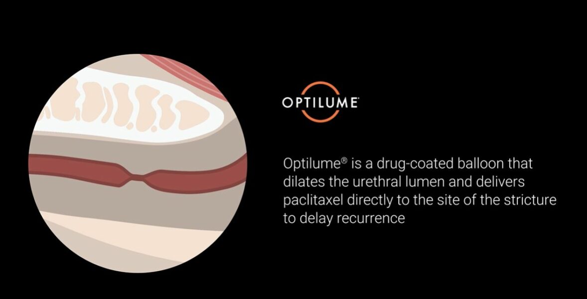Optilume® for Urethral Stricture | Urethral Drug Coated Balloon