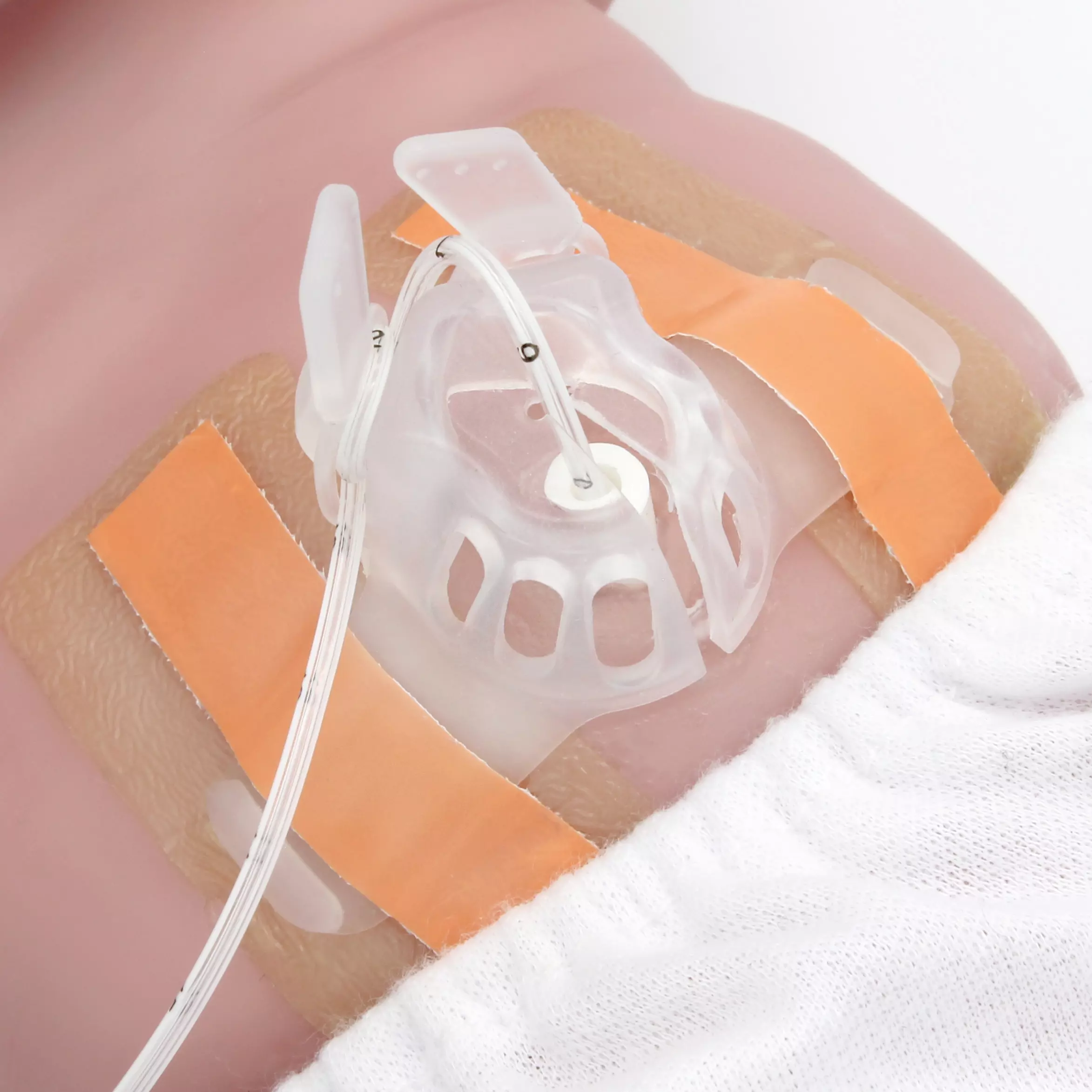LifeBubble™ Umbilical Catheter Securement System - Laborie