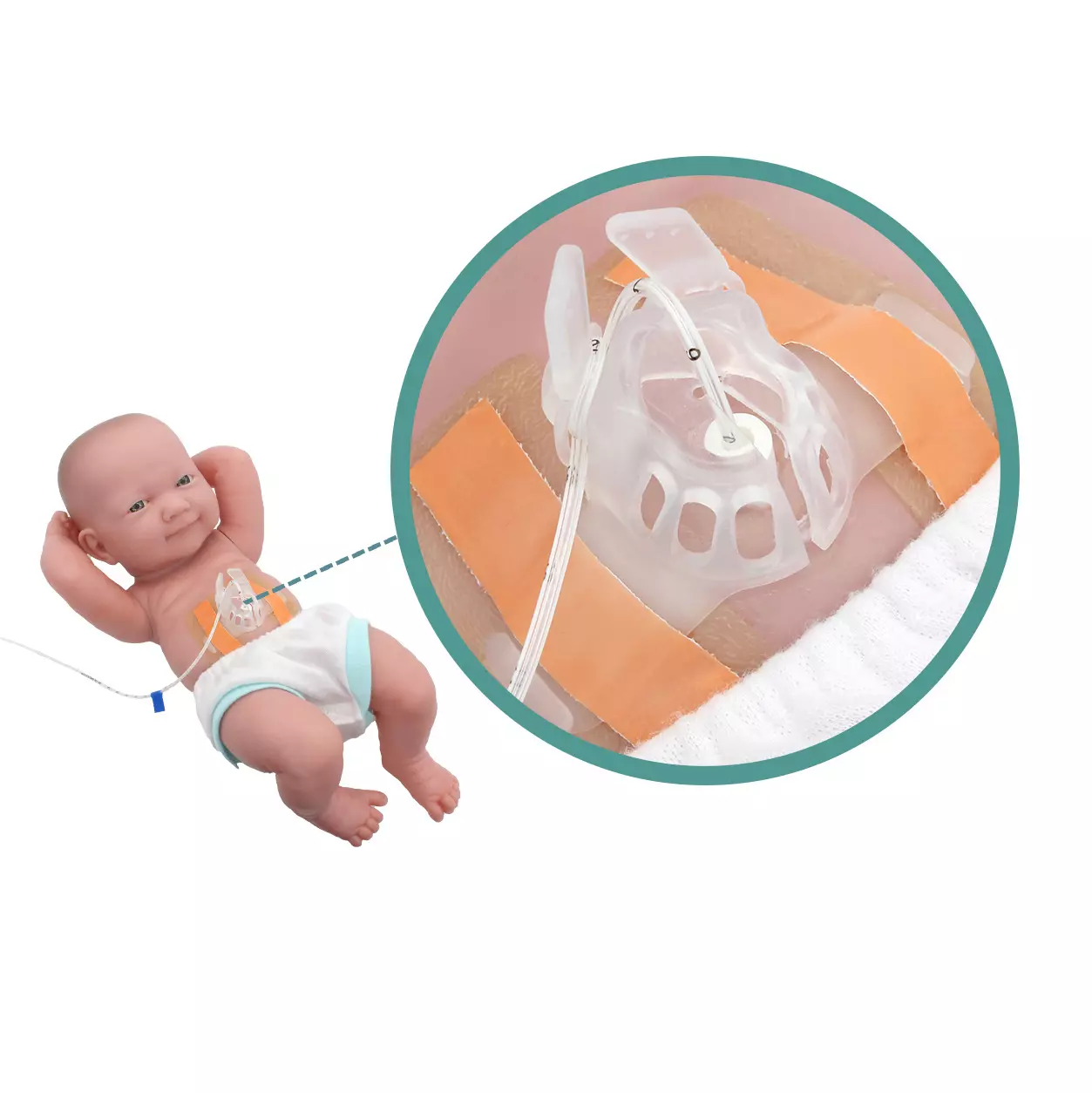 LifeBubble® Umbilical Catheter Securement System - Laborie