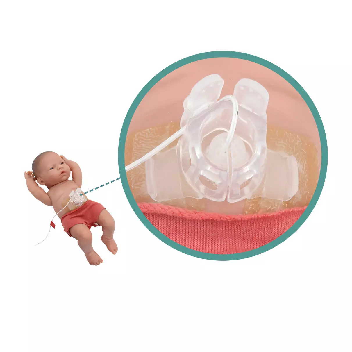 LifeBubble® Umbilical Catheter Securement System - Laborie