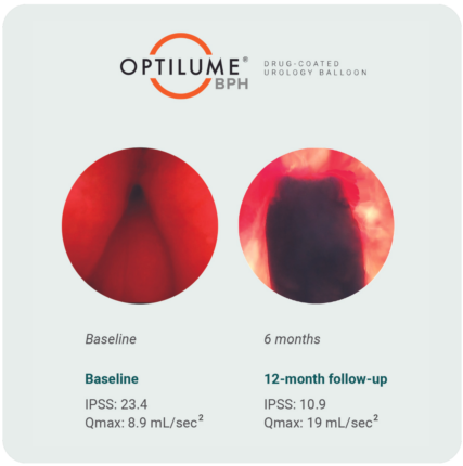 Optilume® BPH Catheter System for the treatment of BPH