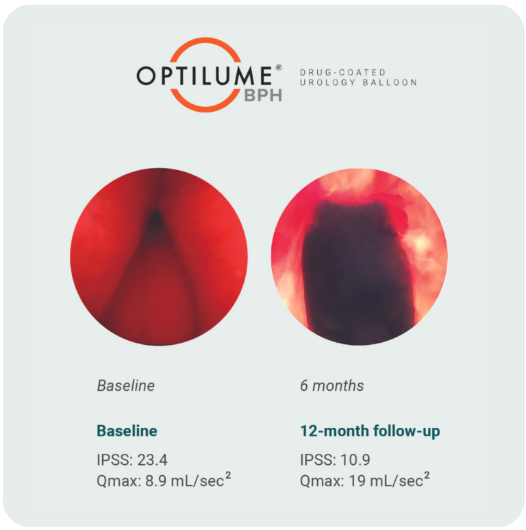 Optilume® BPH Catheter System for the treatment of BPH